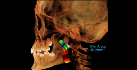 CBCT for Airway Analysis & Dental Sleep Medicine – Capture 3D Radiology