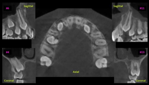 CBCT for Impacted Teeth – Capture 3D Radiology