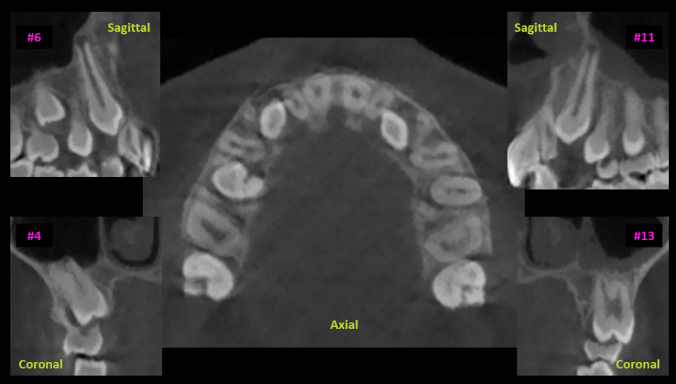 CBCT for Impacted Teeth – Capture 3D Radiology